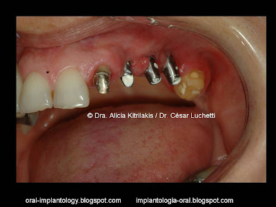 Dental Implants Articles: Bone Expansion by means of Ridge Splitting
