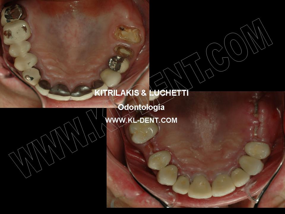 Kitrilakis & Luchetti - Dentistry: Fixed Prosthodontics: Complete ...