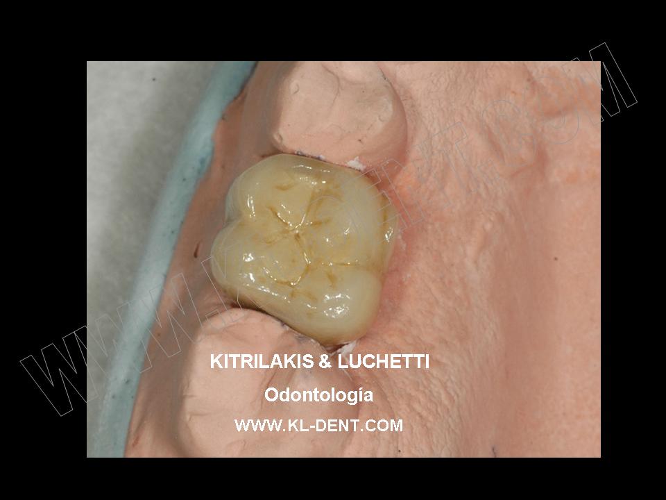 Kitrilakis & Luchetti - Dentistry: Dental Implant in Upper Molar: Case 2