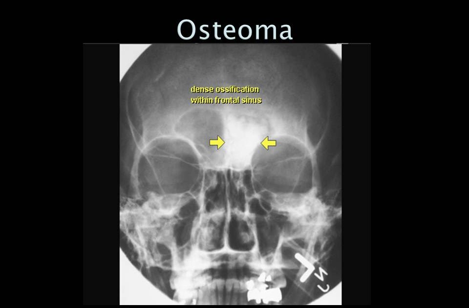 Professor Cesar Augusto Loiacono: OSTEOMA DO SEIO FRONTAL