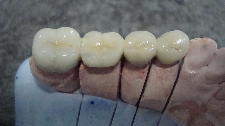 tecnologia dental: METAL PORCELANA