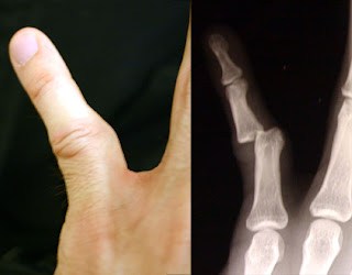 The Astoria Redditor: Health Insurance and Luck.