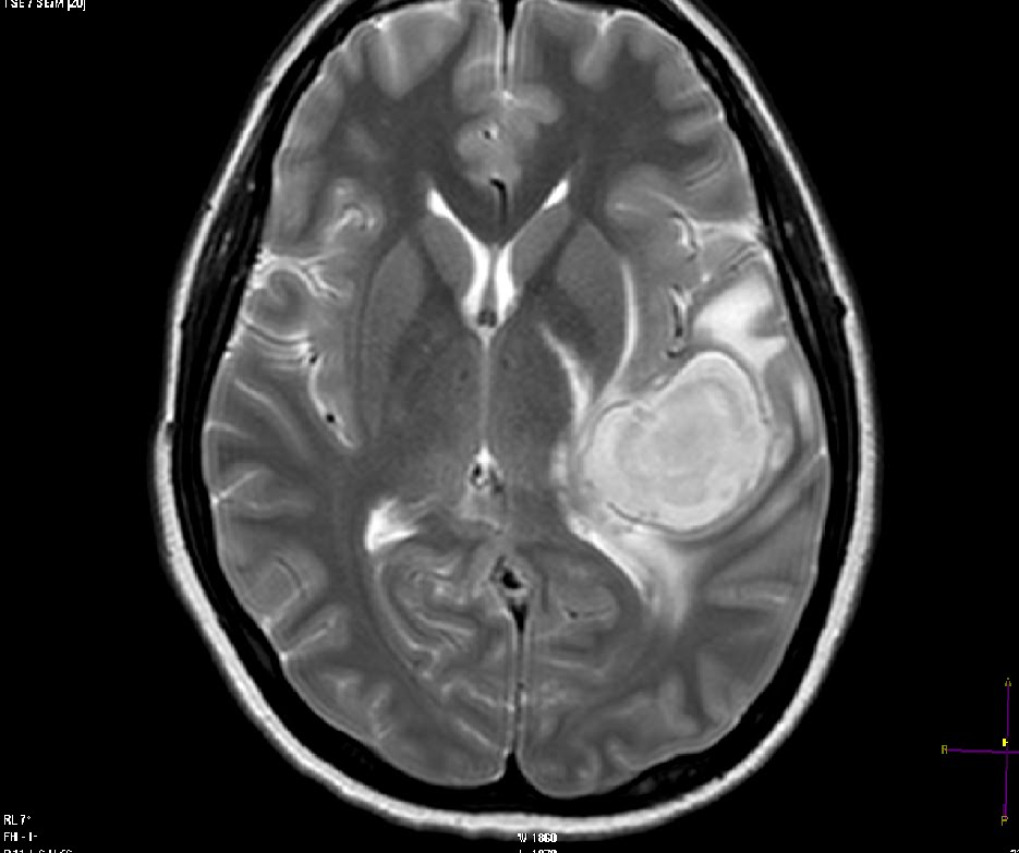 SAATNYA BELAJAR MRI: Tangan kiri dan kaki kiri kesemutan ternyata tumor ...