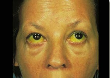 Medical World: Jaundice