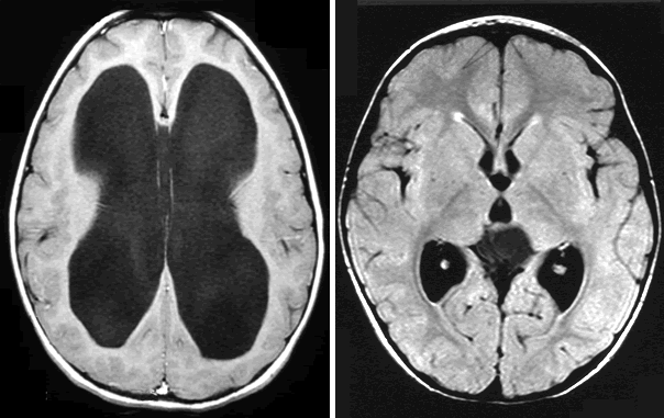 Medical World: Hydrocephalus