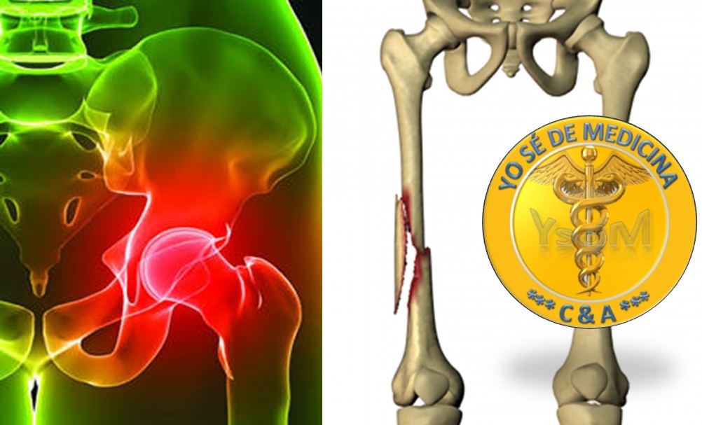 Embolia Grasa; Embolia Grasosa