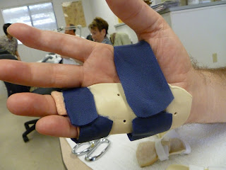 Adventures in Splinting: DIP Blocking Exercise Splint