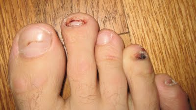 The Holistic Athlete: Runners Toes