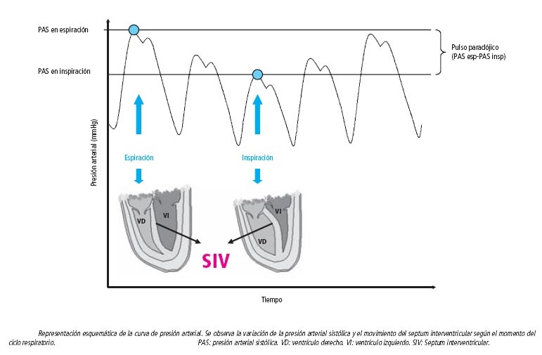 LAS CORONARIAS: Pulso paradójico
