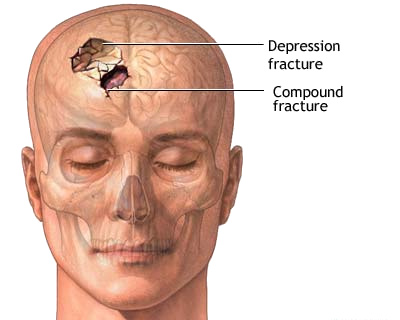 A&P Blog: Bone Fractures