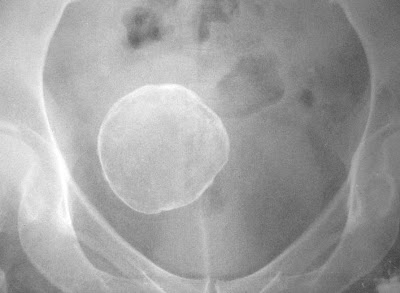 O Radiologista: Calcificação Pélvica