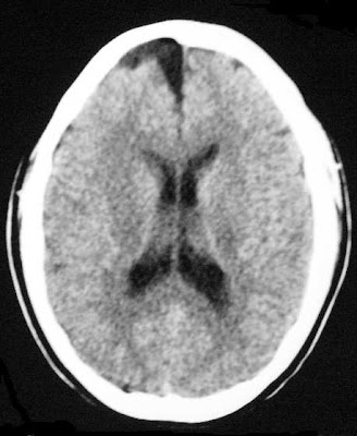 O Radiologista: Higroma Subdural