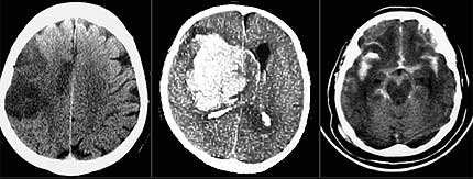 Fisioterapia PUC-Minas: Acidente vascular cerebral isquêmico