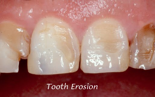 Moore Family Dentistry: Teeth Abrasion and Erosion