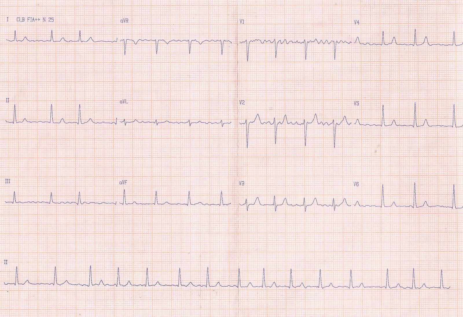 Blog De Eletrocardiografia FibrilaÇÃo Atrial DiagnÓstico E Conduta