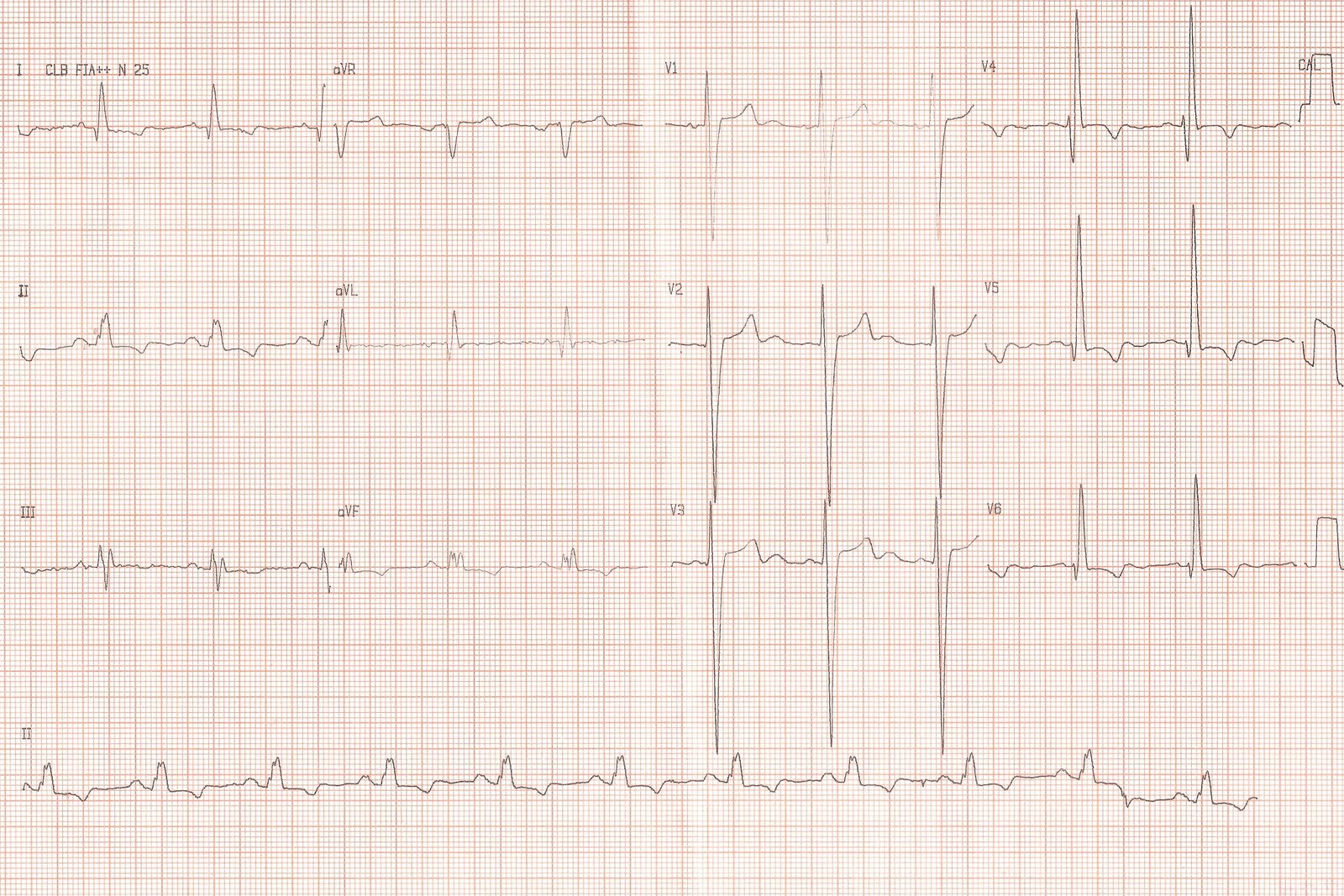 Blog de Eletrocardiografia: ECG PARA DISCUSSÃO
