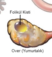 FOLİKÜL KİSTİ