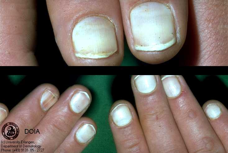 Nossa Podologia.: Leuconíquia