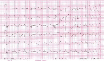 Dr. Wes: EKG Du Jour - #11: Tombstone Alternans