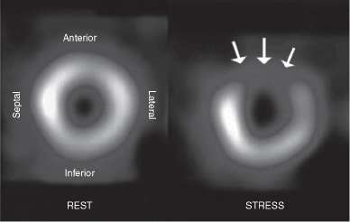 Cardiology secrets: Details of Nuclear cardiology.