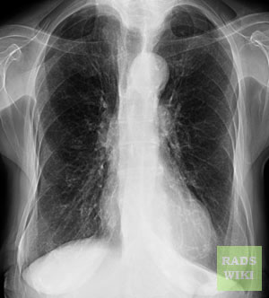 Copd X Ray