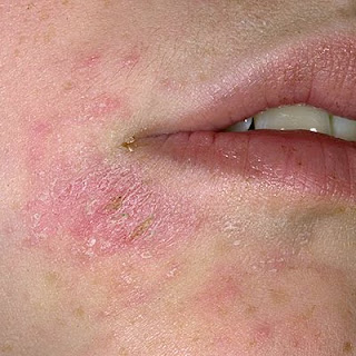how to cure eczema: types of eczema