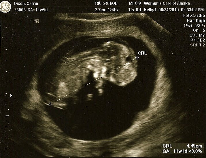 Connor Joseph Casey: 12 week ultrasound - NT Scan