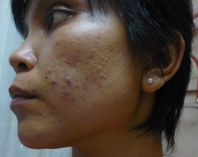 RAJA SEGALA PENAWAR: JERAWAT, RESDUNG, MASALAH USUS DAN ULSER MULUT