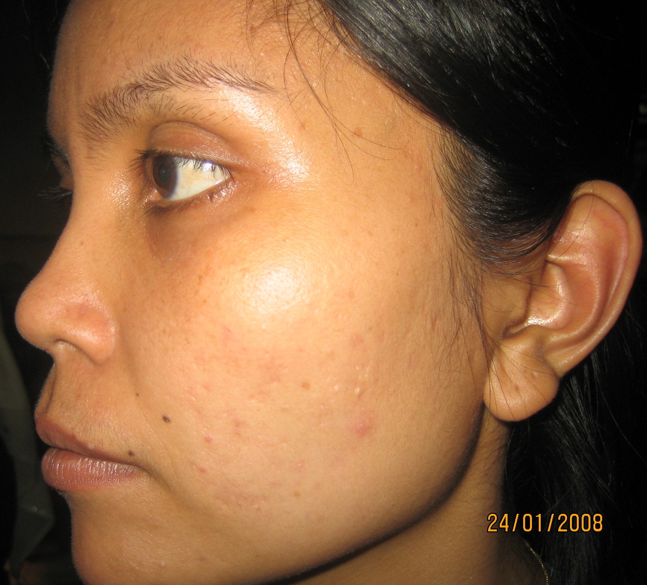 RAJA SEGALA PENAWAR: JERAWAT, RESDUNG, MASALAH USUS DAN ULSER MULUT