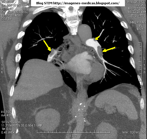 Sobre técnicas de imágenes médicas (Blog STIM): Tromboembolismo ...