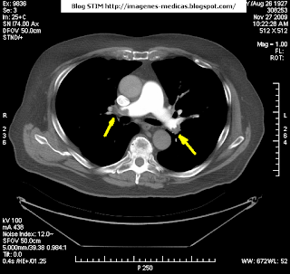 Sobre técnicas de imágenes médicas (Blog STIM): Tromboembolismo ...