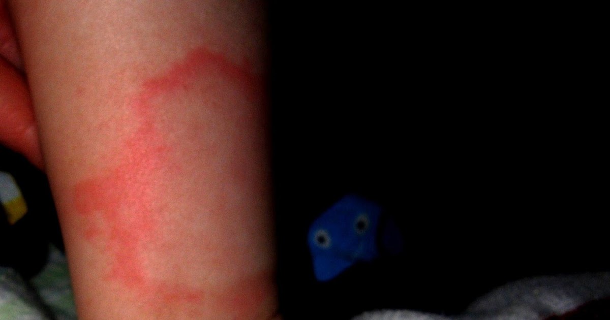 Inside Amy's World: The Annual Summer Stoma Infection