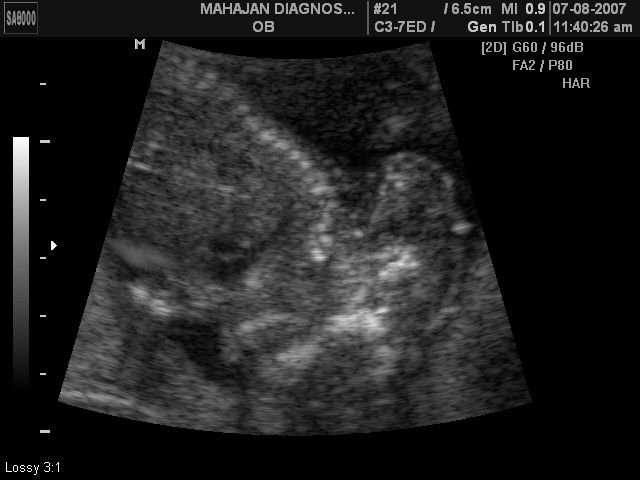 DR.ARUN MAHAJAN: acrania 3d