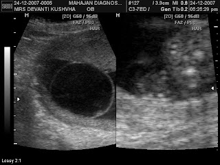 DR.ARUN MAHAJAN: DISCORDANT TWINS