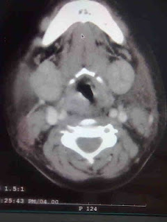 ENT Surgeon's blog: Viral Parotitis and submandibular sialoadenitis ...