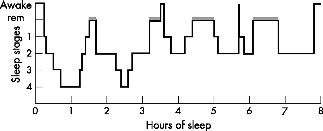 Evolutionary Psychiatry: Sleep Architecture