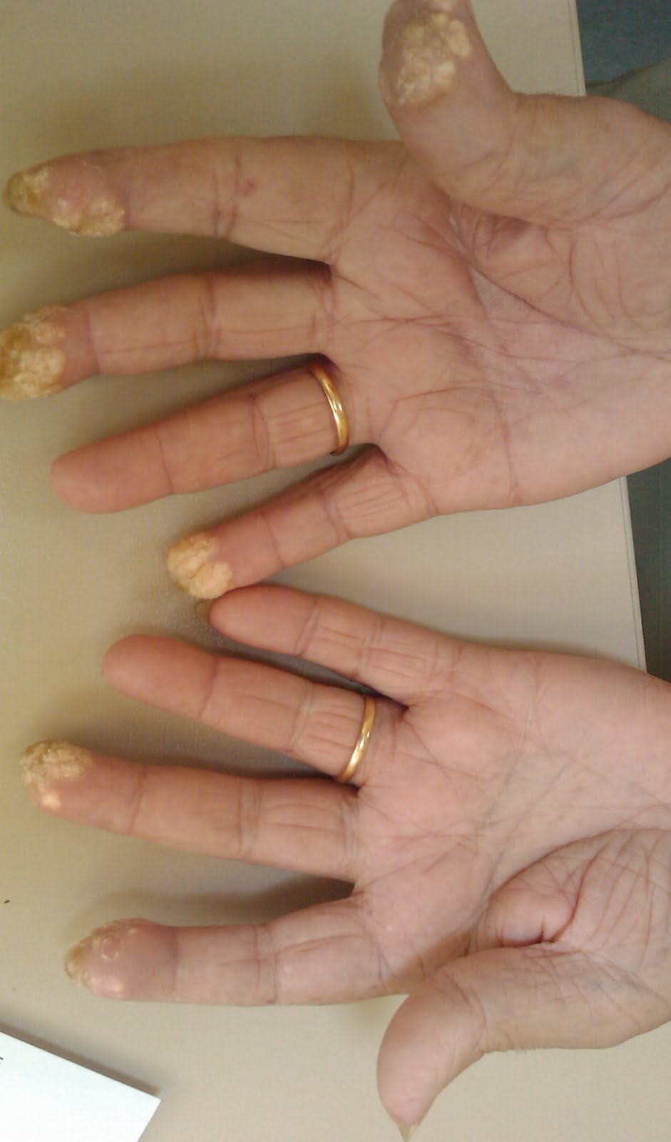 doctor98: Calcinosis en manos en el sindrome CREST