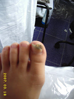 Podología Clinica Lo Vial: Exostosis Primer Ortejo pie Izquierdo zona ...