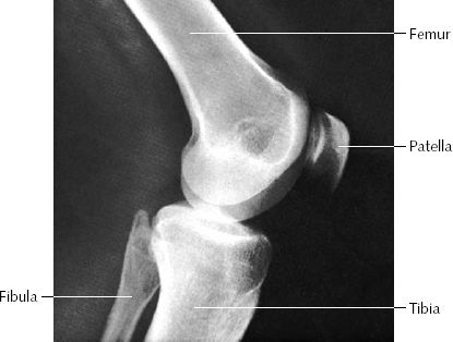 On Ballet, Art and Life: Patella Alta