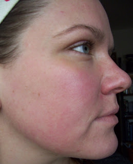 Dr. Humes Says...: Vitahl's Patient Diary of the Pearl Laser