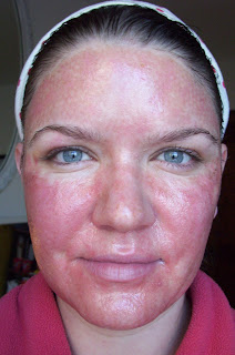 Dr. Humes Says...: Vitahl's Patient Diary of the Pearl Laser