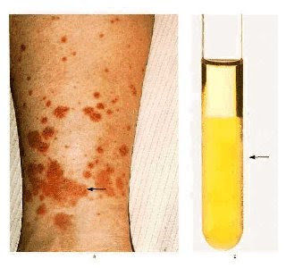 Cryoglobulinemia.. - NEJS