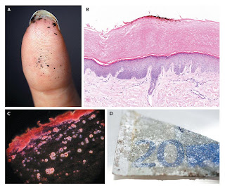 Skin Discoloration... - NEJS