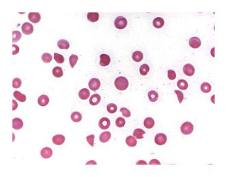 Thrombotic Thrombocytopenic Purpura.. - NEJS