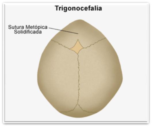 Craneosinostosis: Craneosinostosis