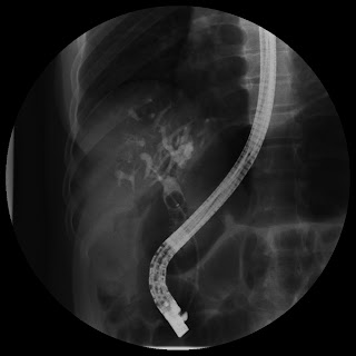 Endoscopía digestiva, vías biliares y páncreas: Caso vías biliares ...