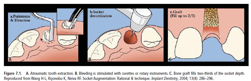 Socket Augmentation: Rationale and Technique | Perio and Implant ...