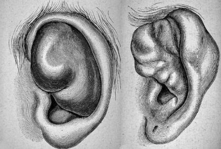 Imágenes de la psiquiatría: 93. ¿Otohematoma u oreja de coliflor?