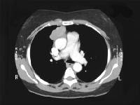 Kathy's MRI Pathology Blog: Thymoma/ Lungs, Mediastinum, Heart