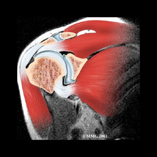 Kathy's MRI Pathology Blog: Frozen Shoulder Syndrome